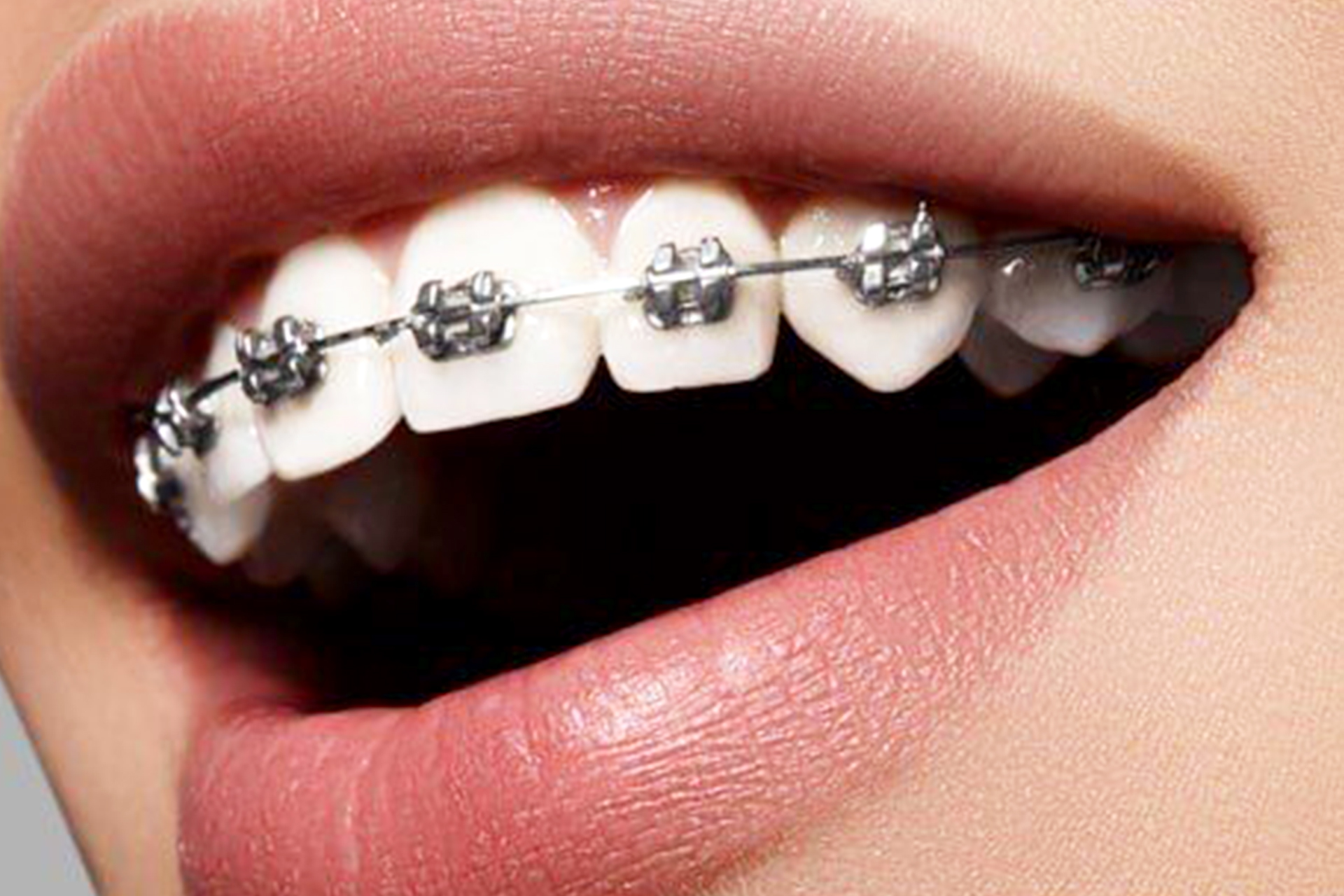 Braces & Aligner system – Dental Artistry